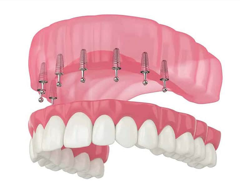 All-On-8 Implants In Albania | American Dental Hospital