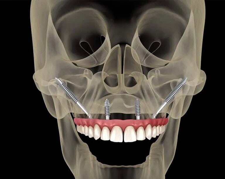 Zygomatic Implants In Albania | American Dental Hospital